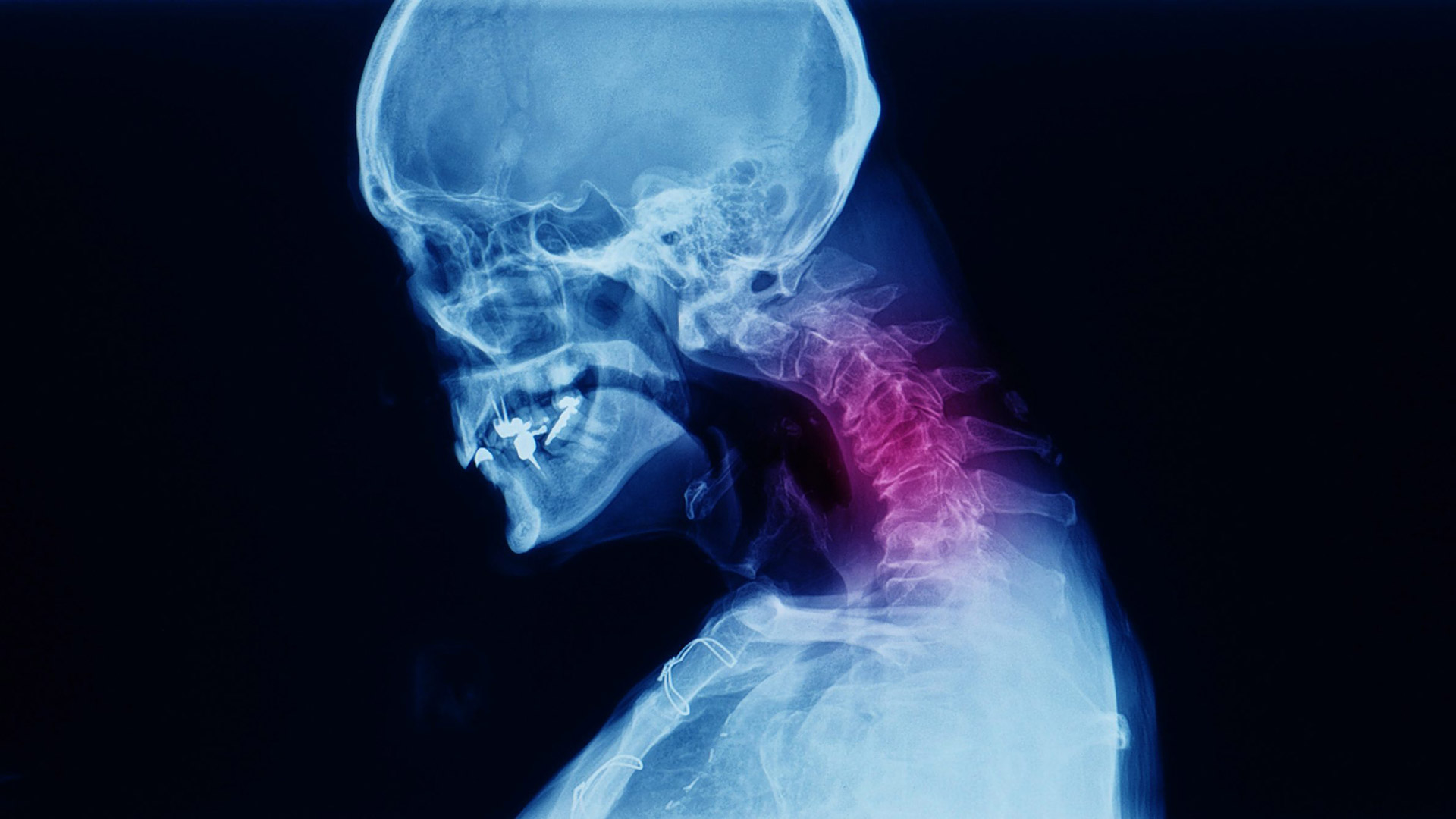 Understanding Cervical Myelopathy: Causes, Symptoms, and Treatment - Dr ...