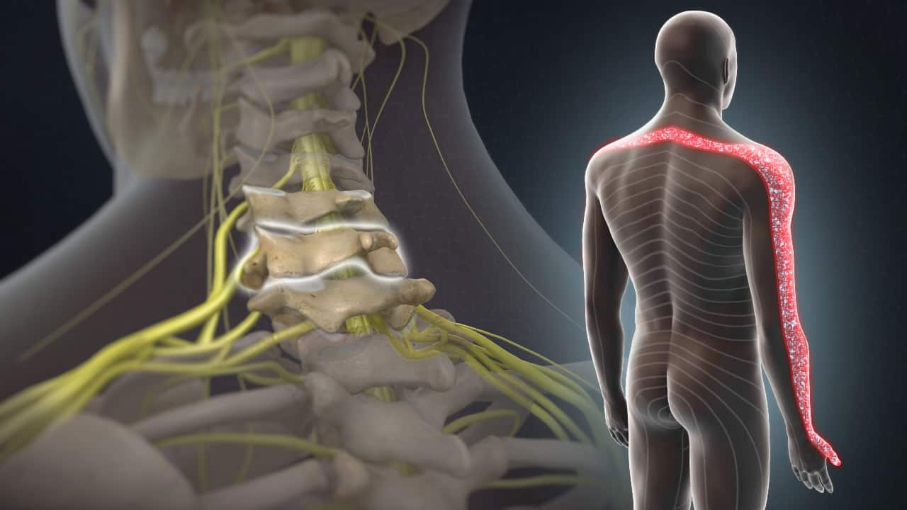 Recognize the Signs of Cervical Myelopathy