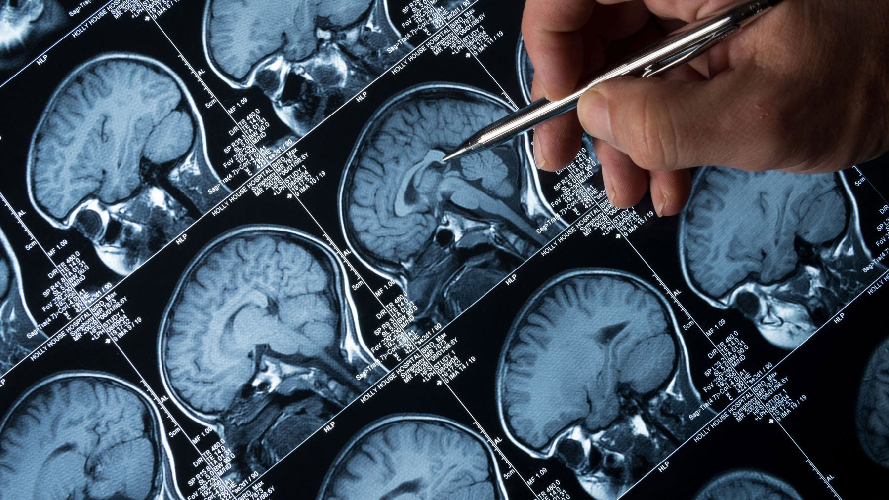 Understanding Glioma: Insights into a Complex Brain Tumor