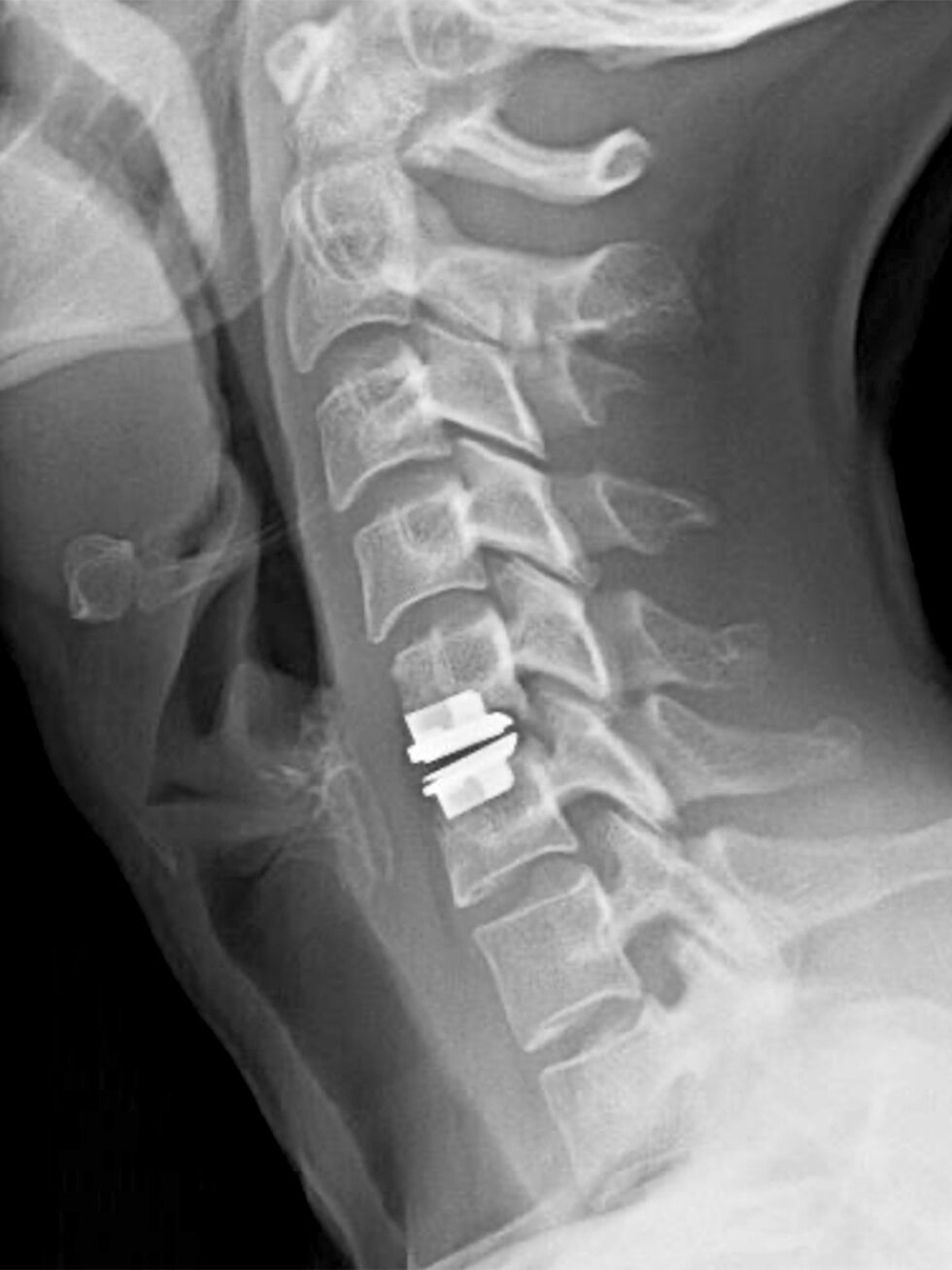 Dr. Eric J Arias, MD - Cervical Radiculopathy