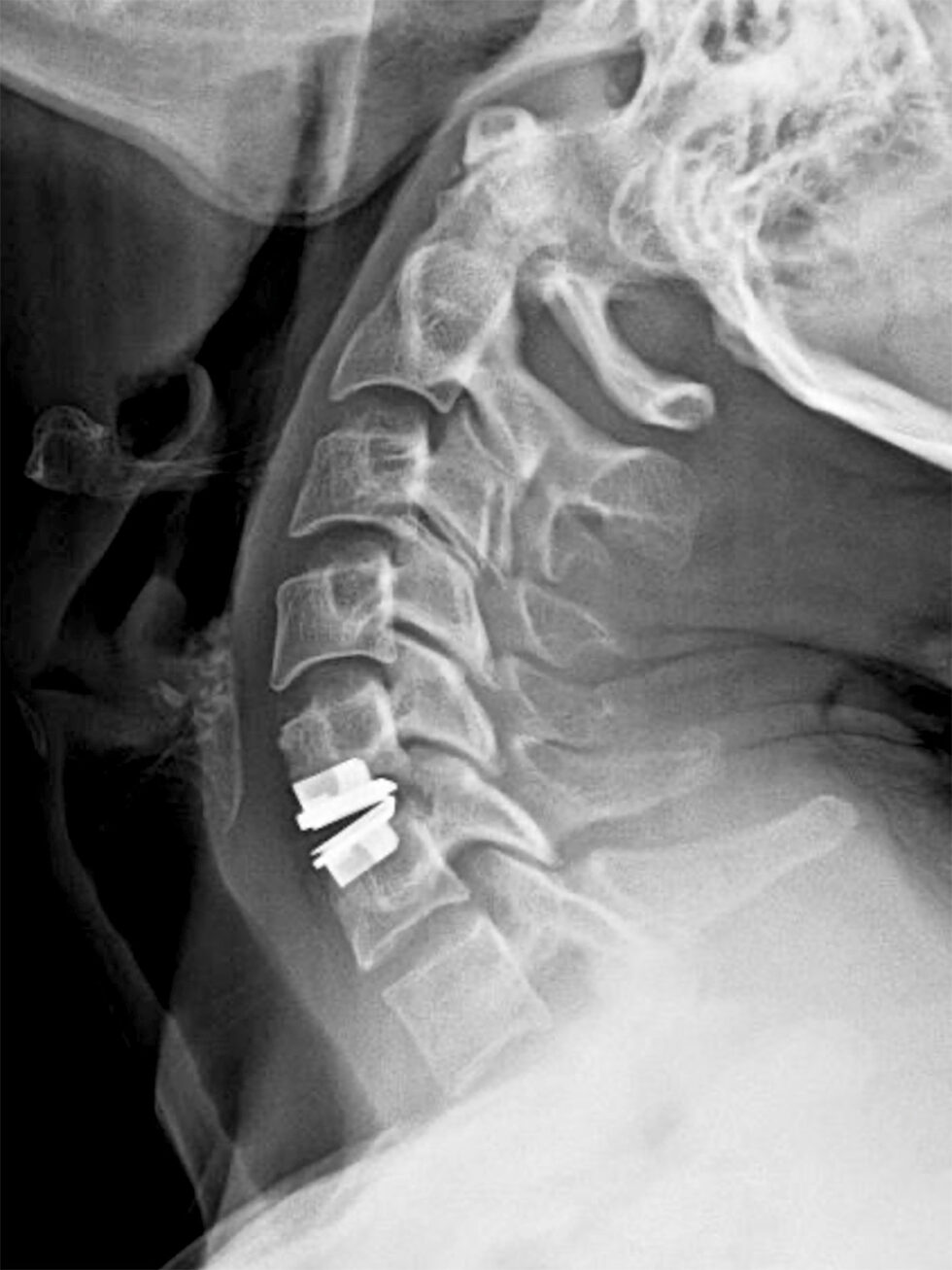 Dr. Eric J Arias, MD - Cervical Radiculopathy